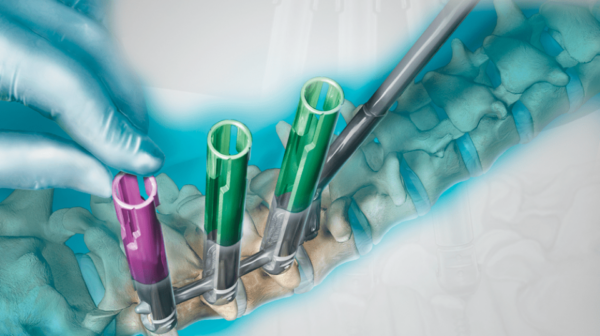 Phoenix® Minimally Invasive Spinal Fixation System – Life Medical Equipment