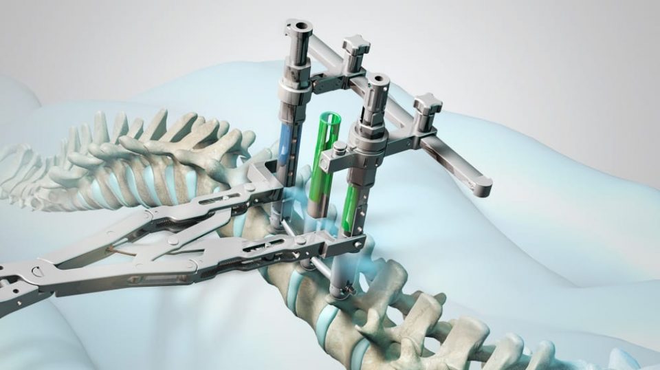 Phoenix CDX Minimally Invasive Spinal Fixation System – Life Medical ...